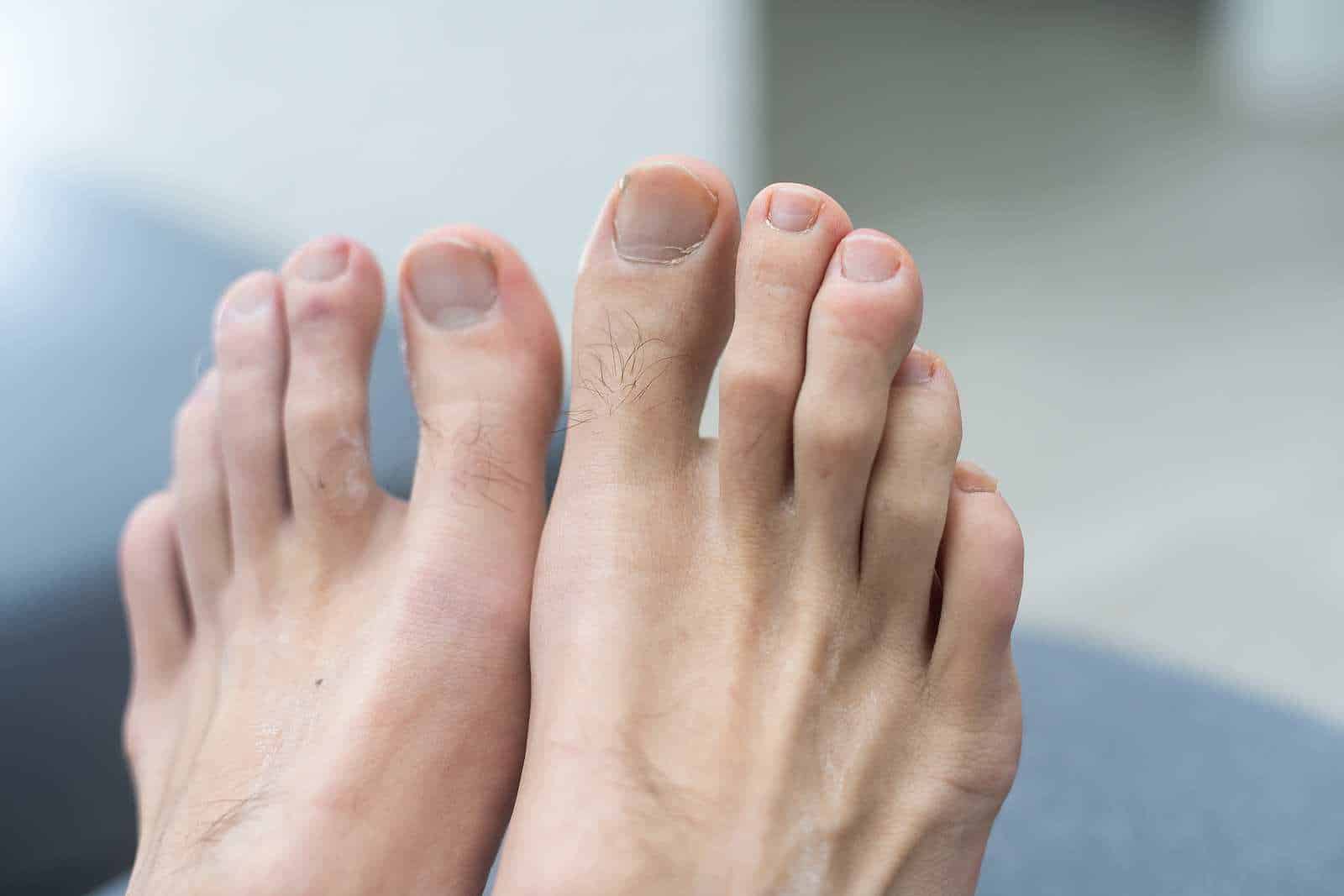 Ingrown Toenail Treatment Ballarat | Modern Medicine